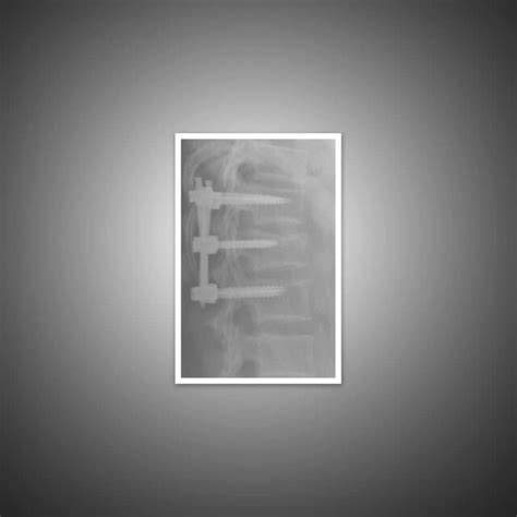 Compression Fractures SpineCare Singapore