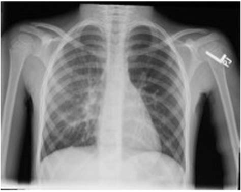 Chest X Ray Demonstrating Hyperlucency Confirming Swyer James Macleod Chest X Ray Demonstrating Hyperlucency Confirming Swyer James Macleod