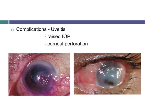 Viral Keratitis Diagnosis And Management Pptx