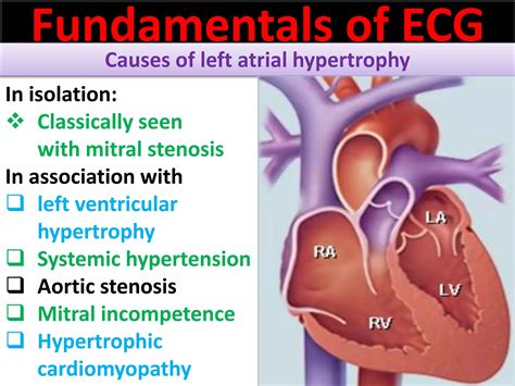 P Wave Abnormalities In Ecg Ppsx