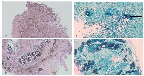 [pdf] Reaction To Ferric Subsulfate Solution Mimicking Cervical