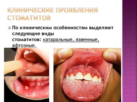 Заболевания слизистой оболочки полости рта презентация онлайн