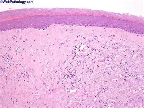 Balanitis Xerotica Obliterans Symptoms Diagnosis And Treatment Midf