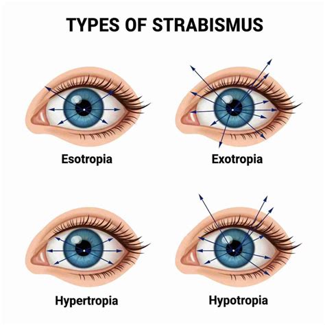 Strabismus Mengenal Gejala Dan Penanganan Mata Juling Inca Hospital