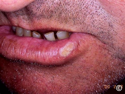 Squamous Cell Carcinoma