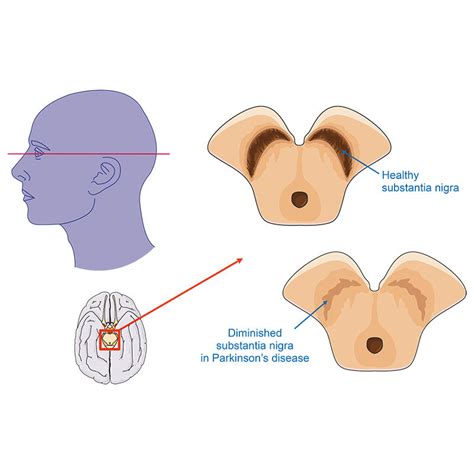Parkinsonova Nemoc Vektorové Vědecké Ilustrace