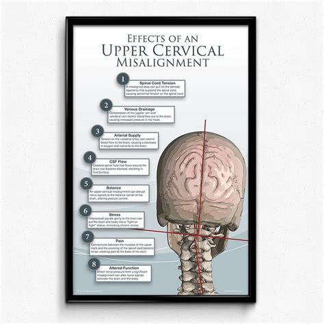 Upper Cervical Posters