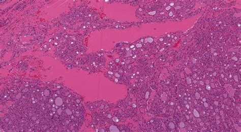 Your Pathology Report For Widely Invasive Oncocytic Carcinoma Of The Thyroid Gland