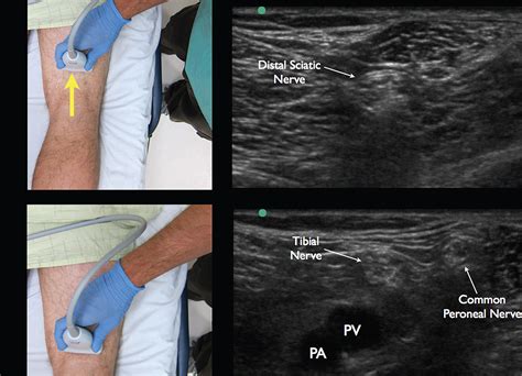 Sciatic Nerve Block