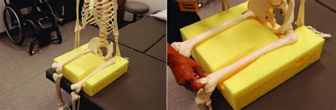 Leg Trough Modification To Address Fixed Hip Extension Deformity
