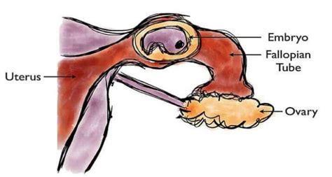 Fallopian Tubes And Fertility Reviva Ivf