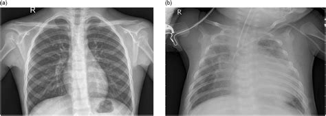 A Normal Chest X Ray Image B Chest X Ray Image Of Patients With