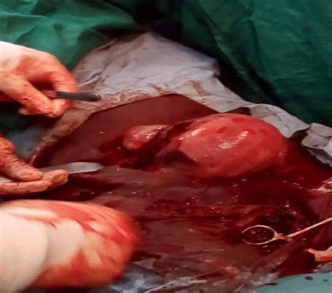 Laparotomy Showing Right Lateral Uterine Rupture White Arrow After