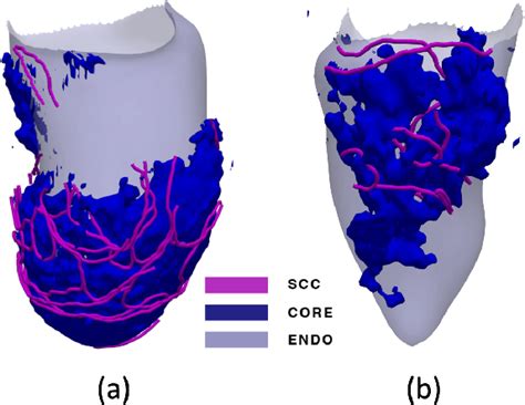Figure 1 From Assessment Of Risk For Ventricular Tachycardia Based On Extensive
