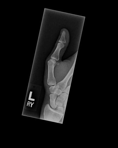 bone fracture detection object detection dataset v4 v4 by veda