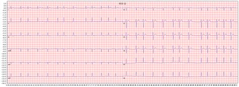Examples Of Ischemic In Inferior Leads Iscin Ecg Library