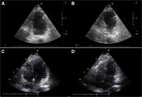 A 53 Year Old Woman With Severe Carbon Monoxide Poisoning Pmc