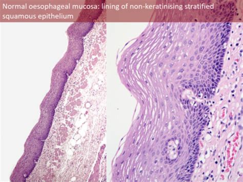 Upper Gi Pathology Flashcards Quizlet
