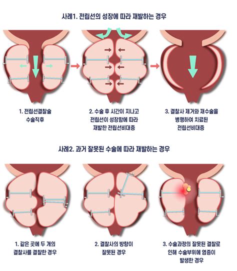 스탠탑비뇨의학과｜전립선수술｜아쿠아 이천건｜유로리프트 삼천건｜발기부전 수술 일만건 돌파｜남성수술 일만오천건 돌파