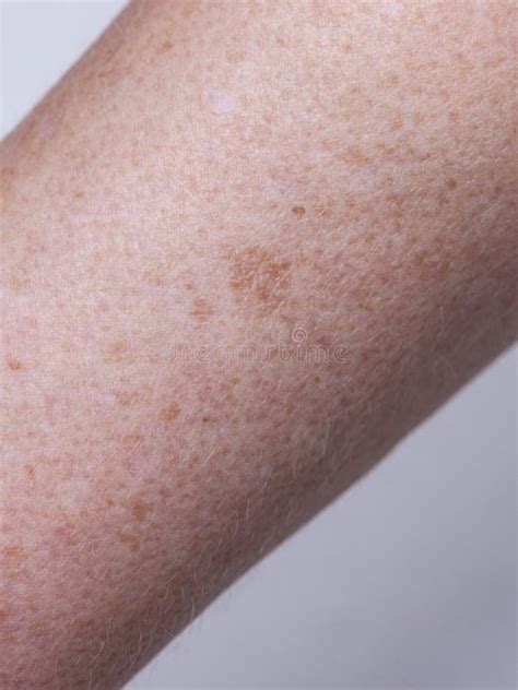 Hyperpigmentation Arms