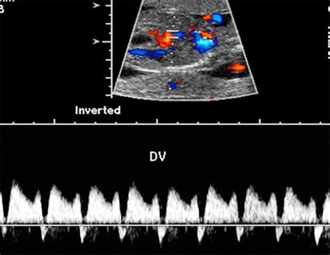Abnormal Ductus Venosus Spectral Doppler Waveform Pattern In A 19 Week