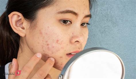 لیزر جای جوش تعداد جلسات هزینه عوارض عکس قبل و بعد