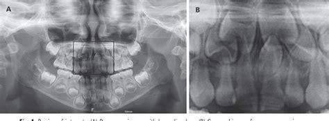 Table 1 From Identification Of Mesiodens Using Machine Learning Application In Panoramic Images