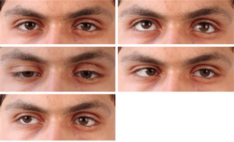 Prosthetic Eye Surgery