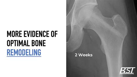 Isabel Hoverman On Linkedin Mg Osteocrete Bone Void Filler Optimal