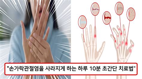 손가락 관절염에 효과적인 3가지 운동법 하루 10분만 투자하여 손가락 관절염을 개선하세요 캐시뉴스