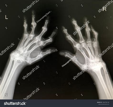 906 Imagens De Rheumatoid Arthritis Xray Imagens Fotos Stock E Vetores