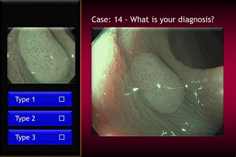 Nice Classification Colon Explorer