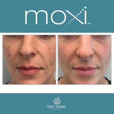 Laser Skin Resurfacing Blue Spiral Medical Spa