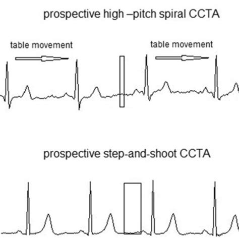 Screenshot Of Ecg Gating In Preparation Of Ccta Prospectively