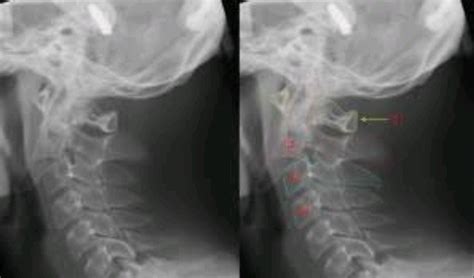 Pavithira Mahalingam On Linkedin A Hangmans Fracture Is A Bilateral Fracture Traversing The Pars…