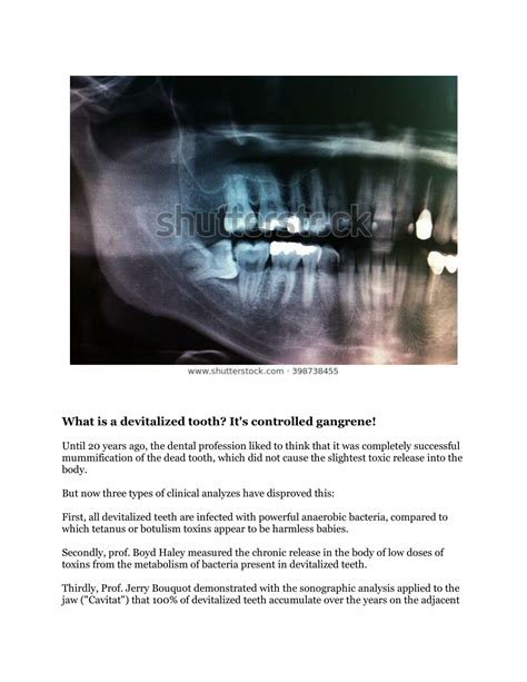 Ppt The Problem Of Devitalized Teeth Powerpoint Presentation Free