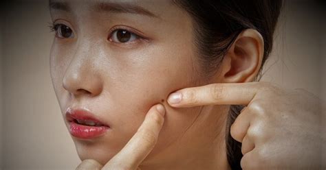 오래가는 여드름 흉터 ‘내 손 때문