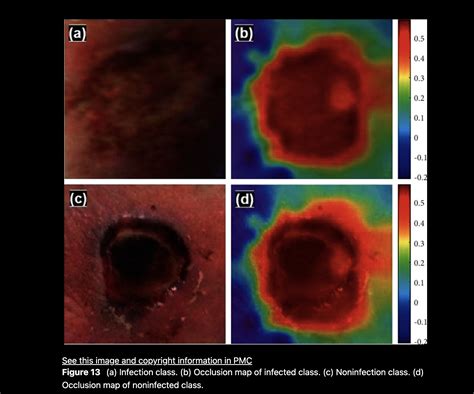 Automated Detection Of Infection In Diabetic Foot Ulcer Images Ai