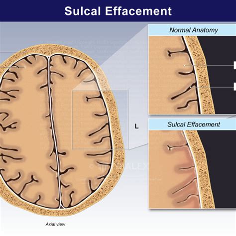 Medical Legal Exhibits Legal Animations And Trial Graphics Tria