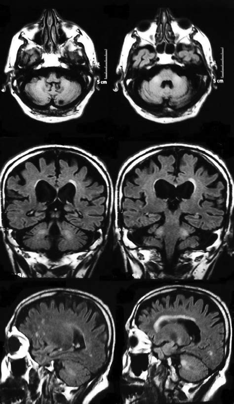 Cranial Mri Showing Generalized Cerebral Atrophy And Increased T2 Download Scientific Diagram