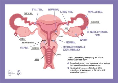Ectopic Pregnancy Locations