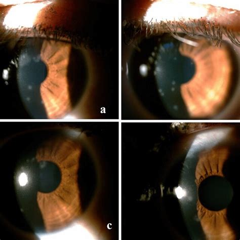 Anterior Segment Photograph Of The Right Eye Showing Punctate Download Scientific Diagram