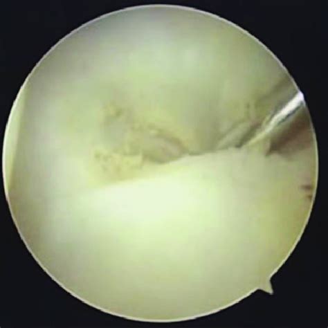 Hook Test The Triangular Fibrocartilage Complex Is Elevated By Pulling Download Scientific