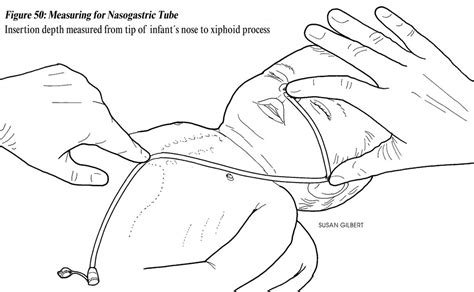 CasesBlog Medical And Health Blog How To Confirm A Nasogastric Tube NGT Placement By CXR