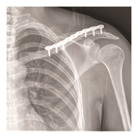 Midshaft Clavicle Fracture Treatment At Annabelle Wang Blog