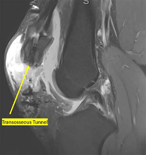 Preoperative T2 Sagittal Magnetic Resonance Imaging Showing Previous Download Scientific