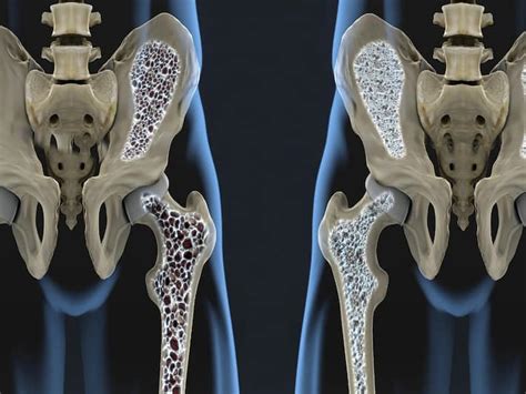Bone Loss From Osteoporosis Air Pollution Can Damage Your Bone Health