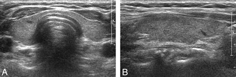 Sonographic Differentiation Of Asymptomatic Diffuse Thyroid Disease From Normal Thyroid A Sonographic Differentiation Of Asymptomatic Diffuse Thyroid Disease From Normal Thyroid A