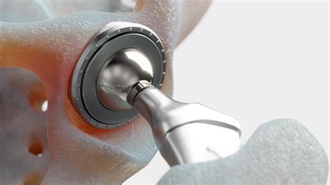 Active Medical Devices Vs Passive Medical Devices