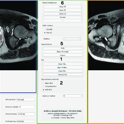Gui Interface Of The Developed Active Contour Segmentation Tool Using A Download Scientific